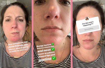 The Sneaky and Surprising Cause of Your Winter Face Rash