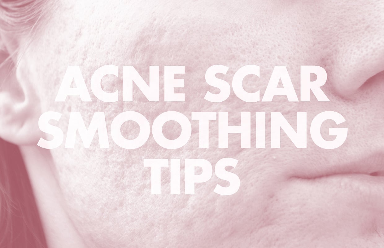 How To Smooth Indented Acne Scars On Your Skin - Renée Rouleau