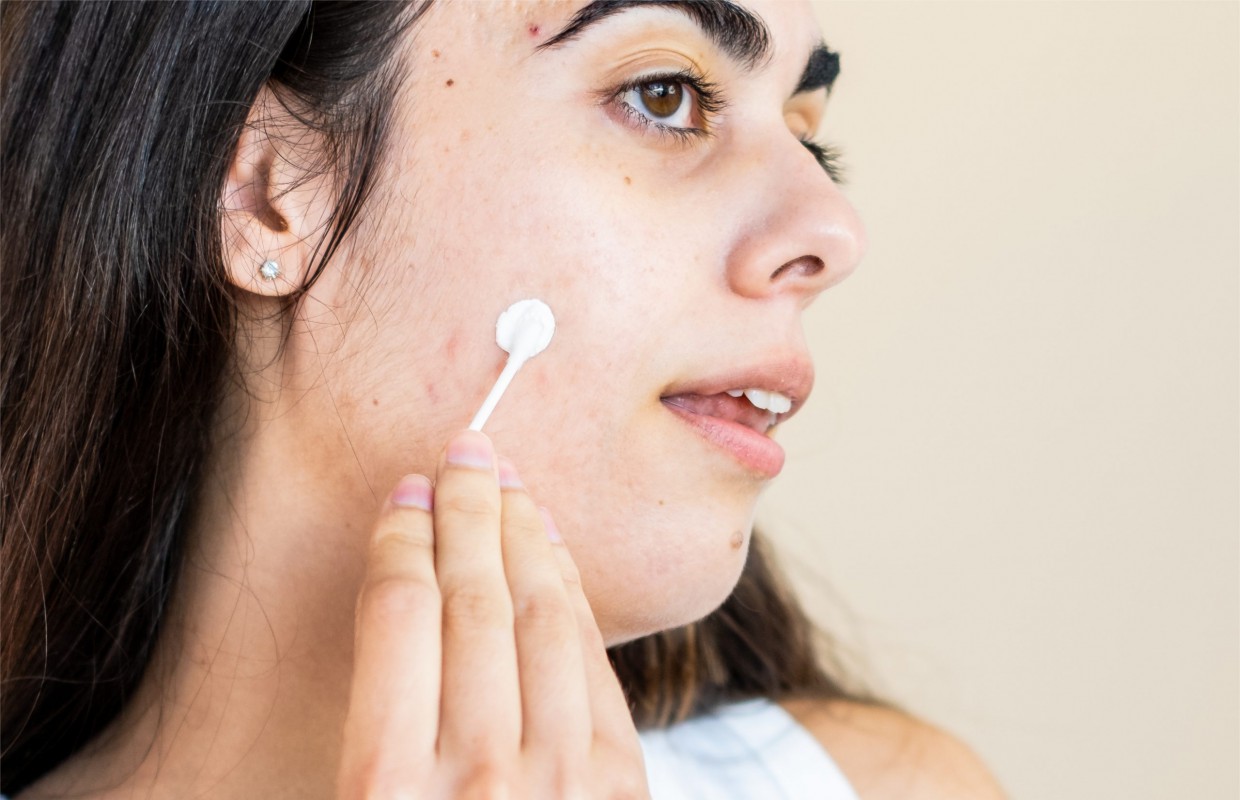 Amanda's IUD Caused Hormonal Acne—Here's How She Fixed It