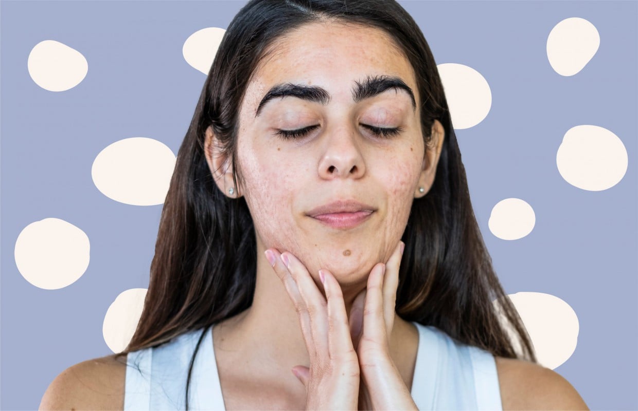 Prevent Chin & Jawline Breakouts With These 8 Expert-Approved Tips