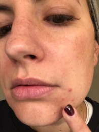 How to Get Rid Of Sudden Acne Breakouts That Come Out Of Nowhere