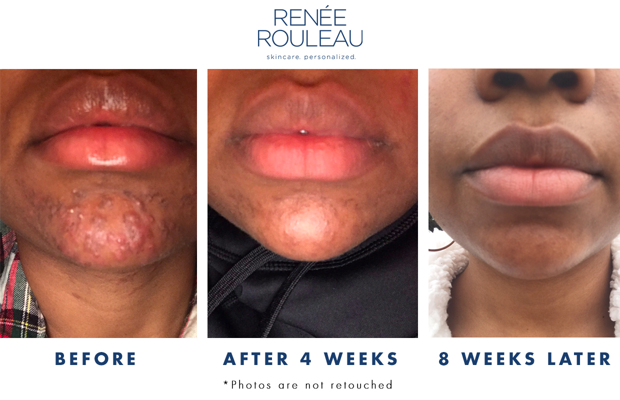 Amanda s IUD Caused Hormonal Acne Here s How She Fixed It Amanda s IUD Caused Hormonal Acne Here s How She Fixed It