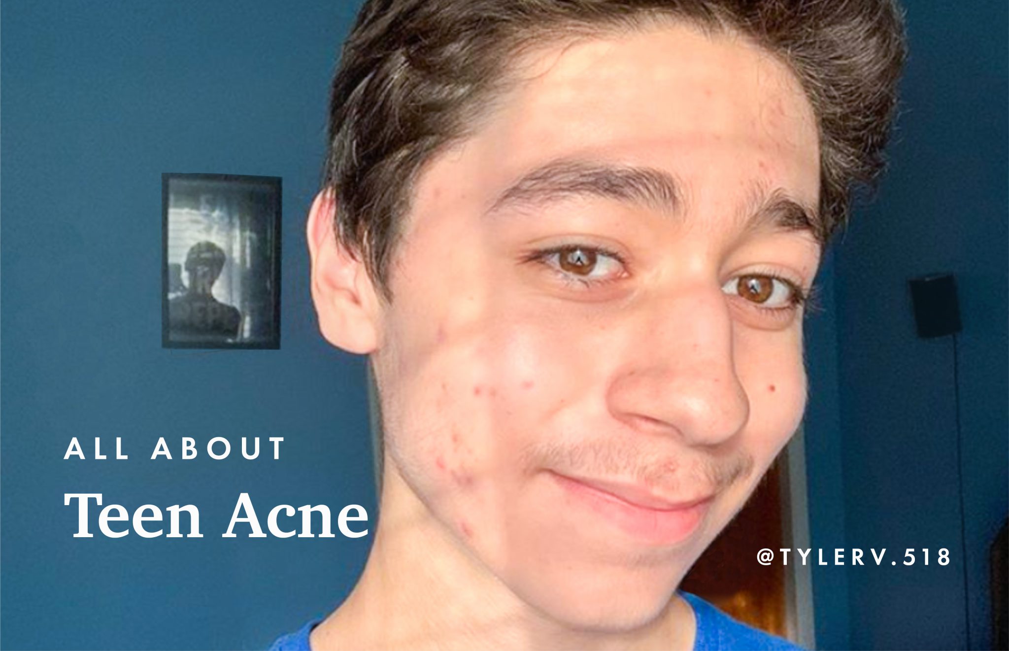 Here's How to Start Managing Teenage Acne at Every Stage