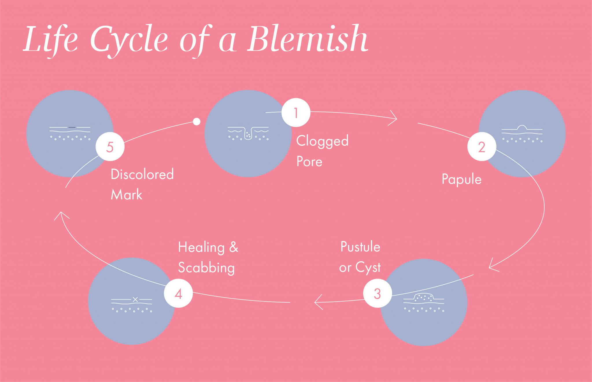 The 5 Stages of Acne and How to Spot-Treat Each One