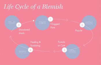 The 5 Stages of Acne and How to Spot-Treat Each One
