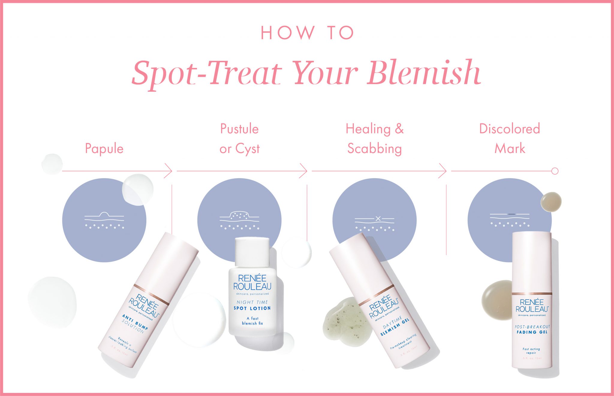 The 5 Stages of Acne and How to Spot-Treat Each One