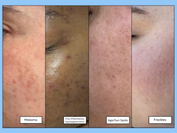Types of Skin Discoloration & How to Get Rid of Them Fast