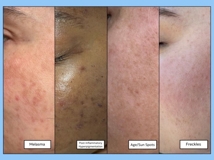 Types of Skin Discoloration & How to Get Rid of Them Fast