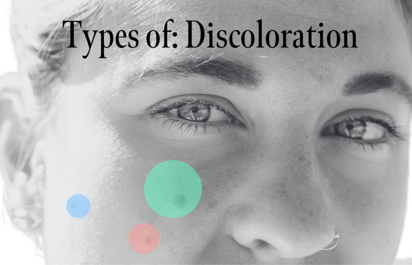Types of Skin Discoloration & How to Get Rid of Them Fast