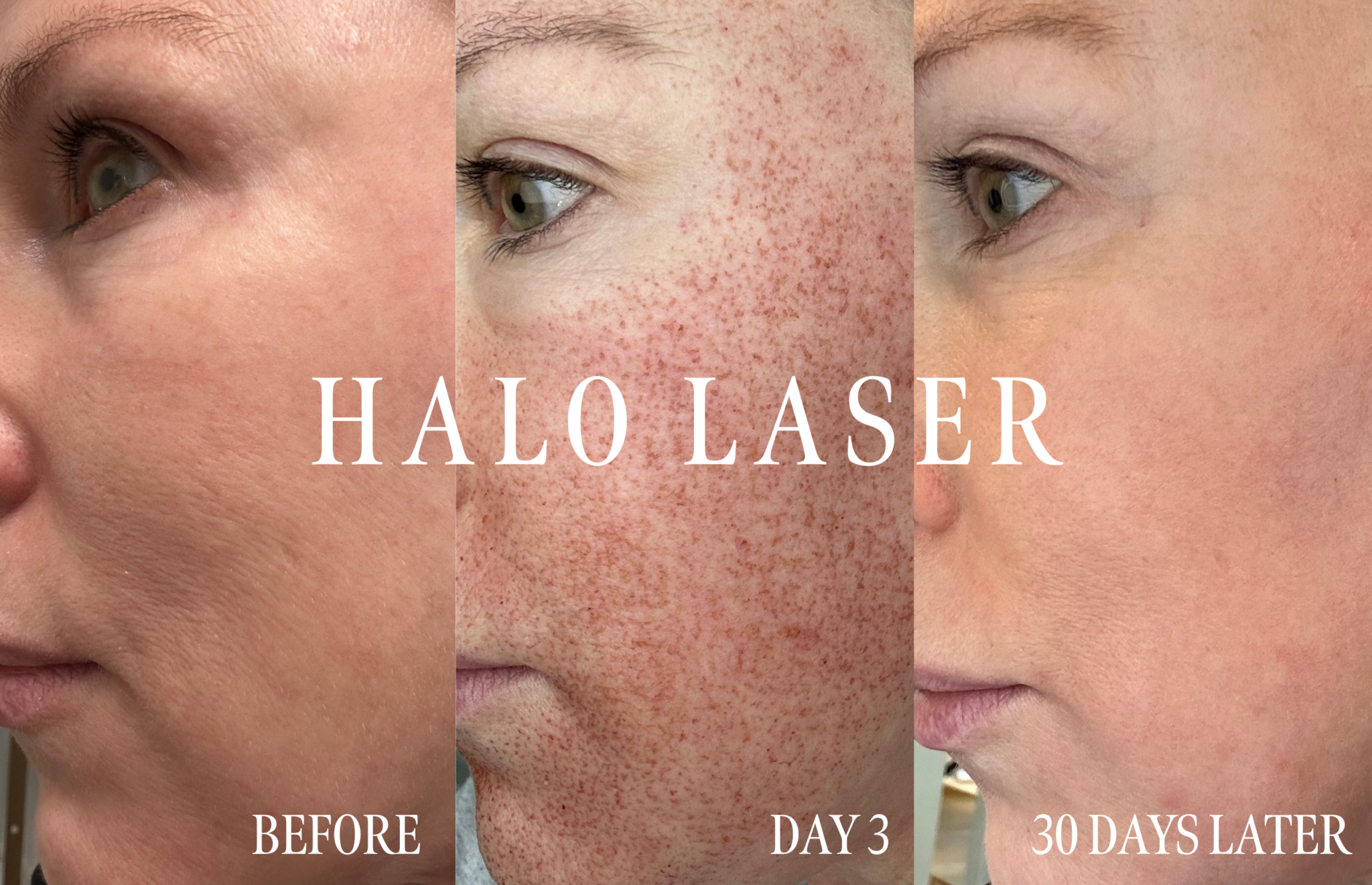 An Esthetician's Halo Laser Review And Recovery